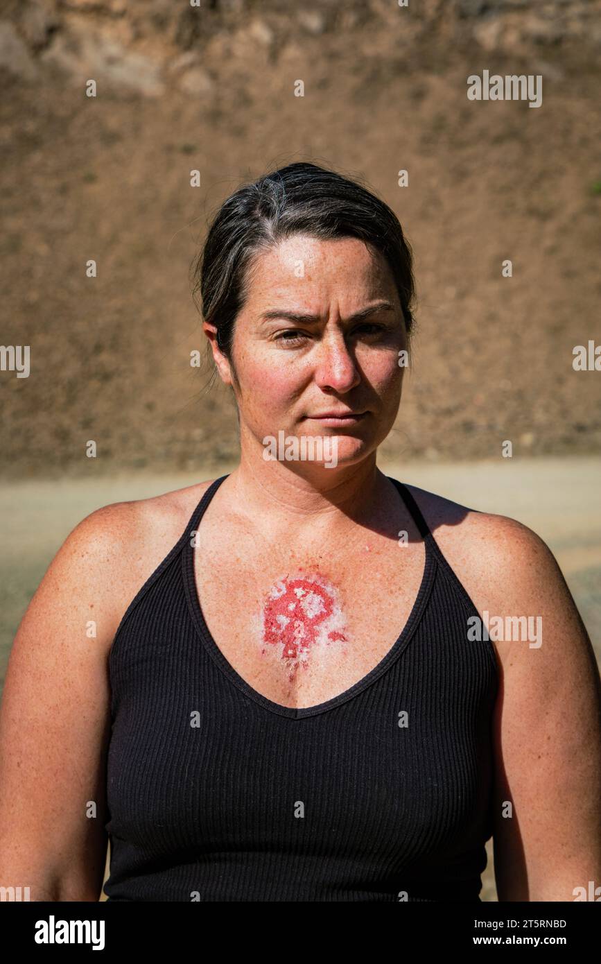 donna caucasica degli anni '30 che mostra un carcinoma superficiale ...