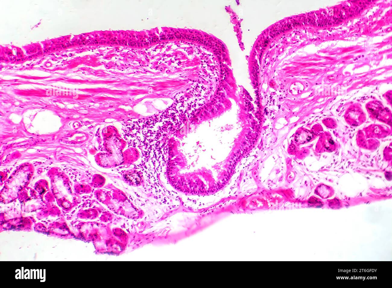 Fotomicrografia della metaplasia squamosa epiteliale bronchiale, che ...
