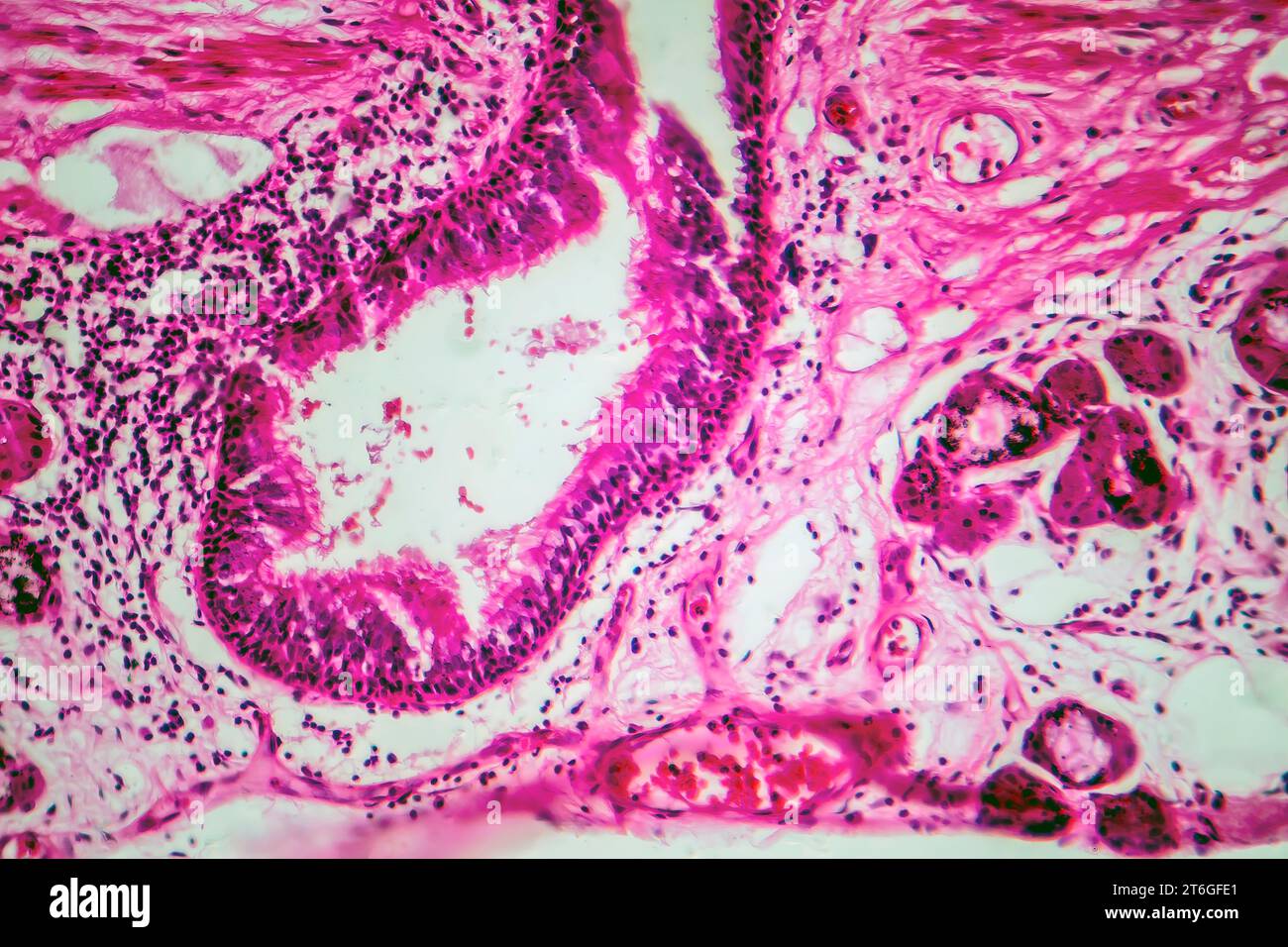 Fotomicrografia della metaplasia squamosa epiteliale bronchiale, che ...