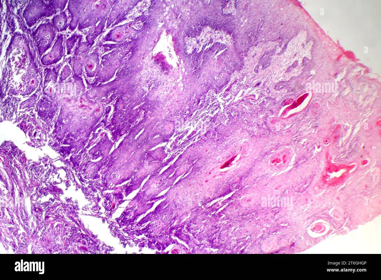 Fotomicrografia del carcinoma cutaneo a cellule squamose, raffigurante ...