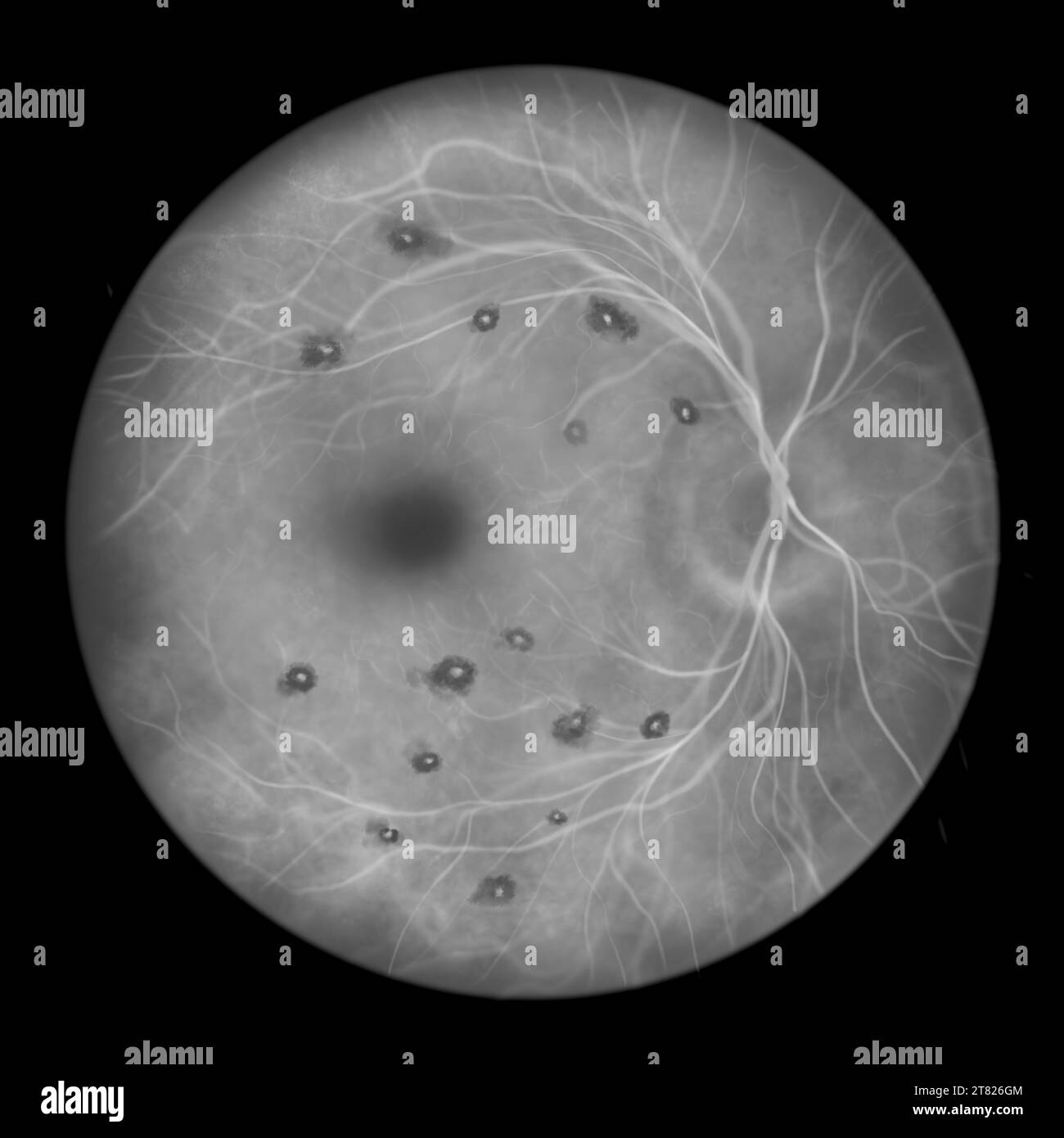 Lupus eritematoso sistemico immagini e fotografie stock ad alta ...