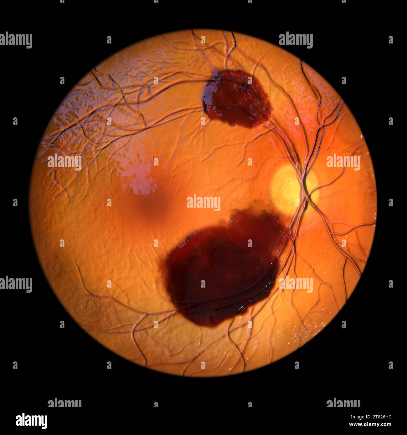 Emorragia retinica immagini e fotografie stock ad alta risoluzione - Alamy