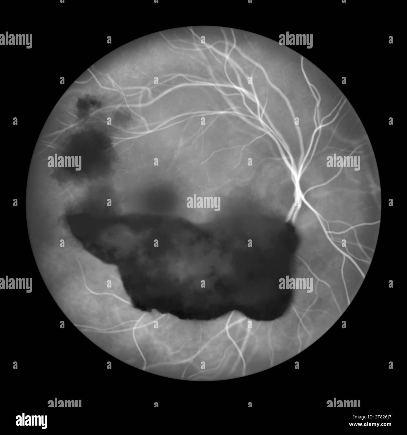 Emorragia del corpo vitreo immagini e fotografie stock ad alta ...