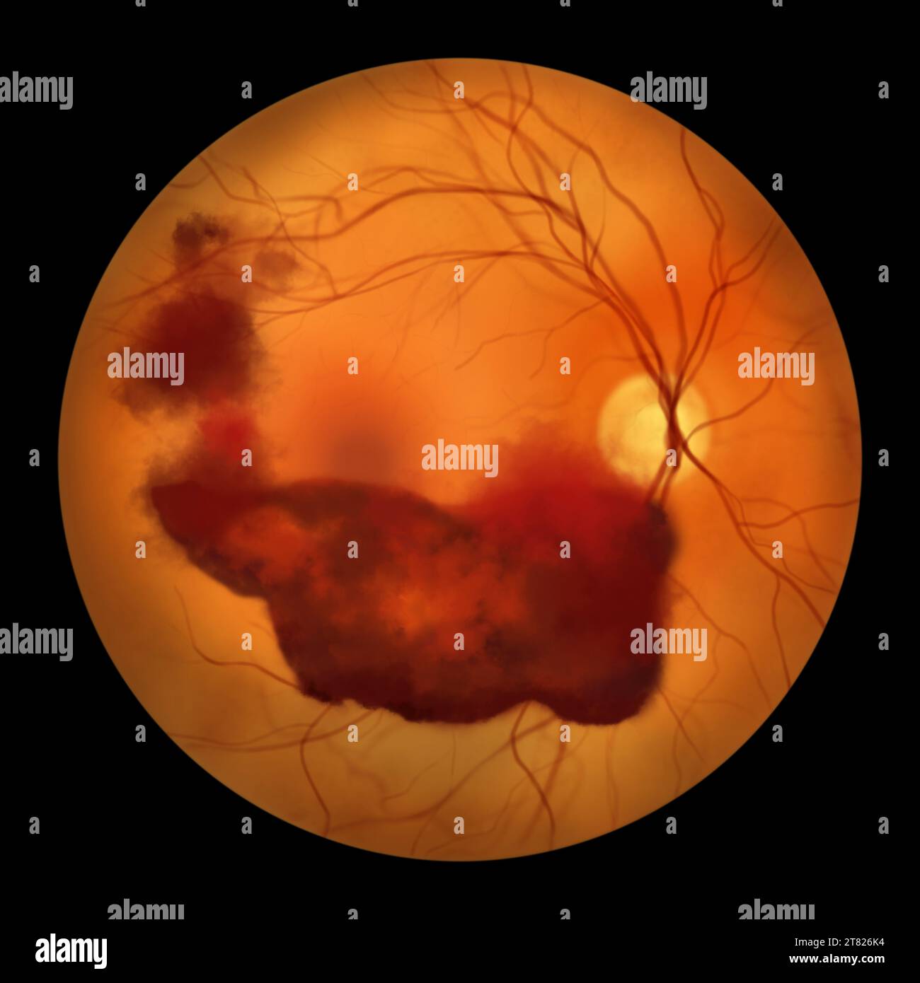 Emorragia del corpo vitreo immagini e fotografie stock ad alta ...