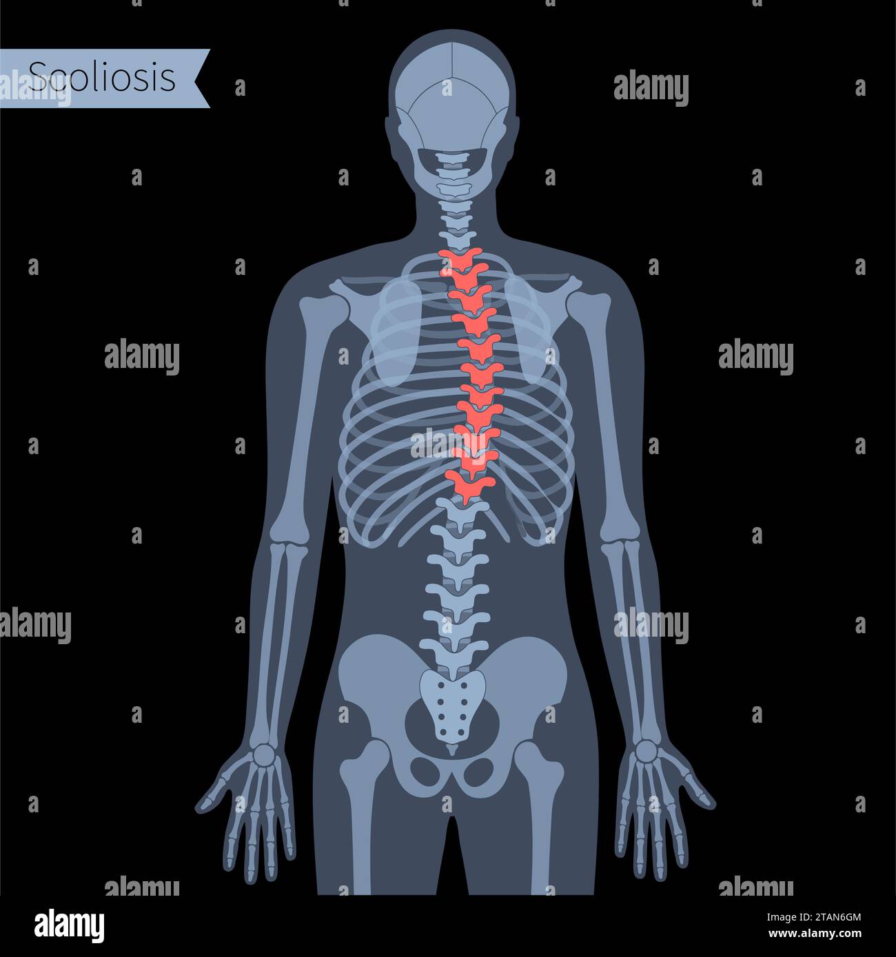 Scoliosi toracica immagini e fotografie stock ad alta risoluzione - Alamy