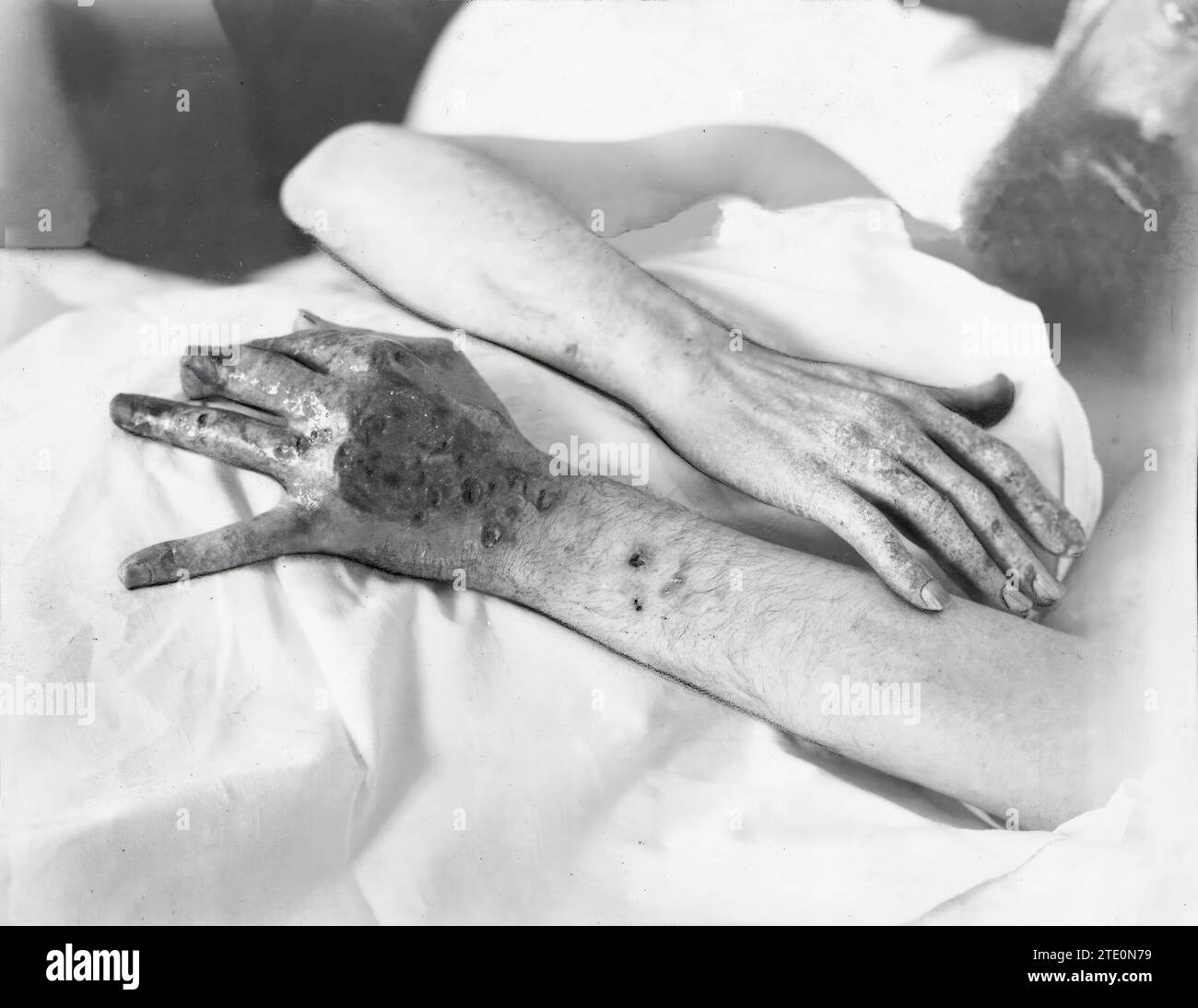 Siviglia, agosto 1915. Dottor José Manuel de Puelles, costretto a letto, vittima dei suoi ...