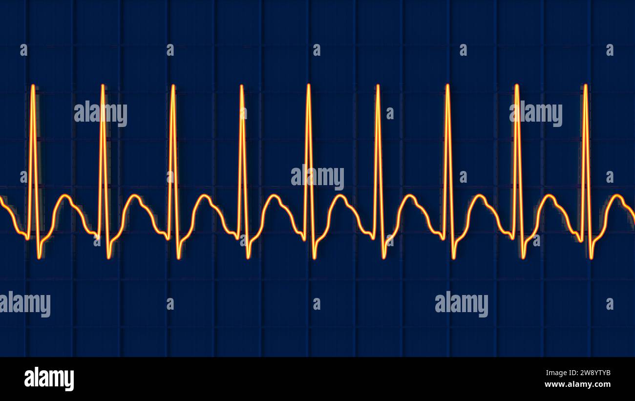 Flutter atriale ekg immagini e fotografie stock ad alta risoluzione - Alamy