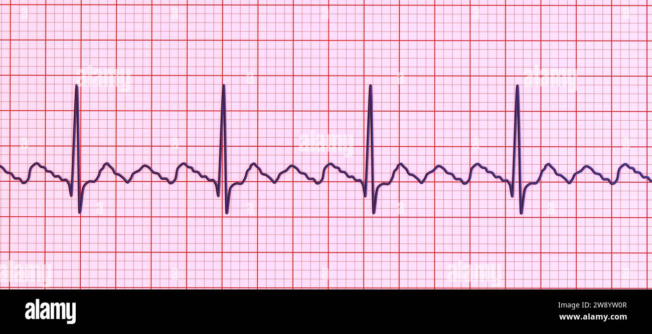 Flutter atriale ekg immagini e fotografie stock ad alta risoluzione - Alamy