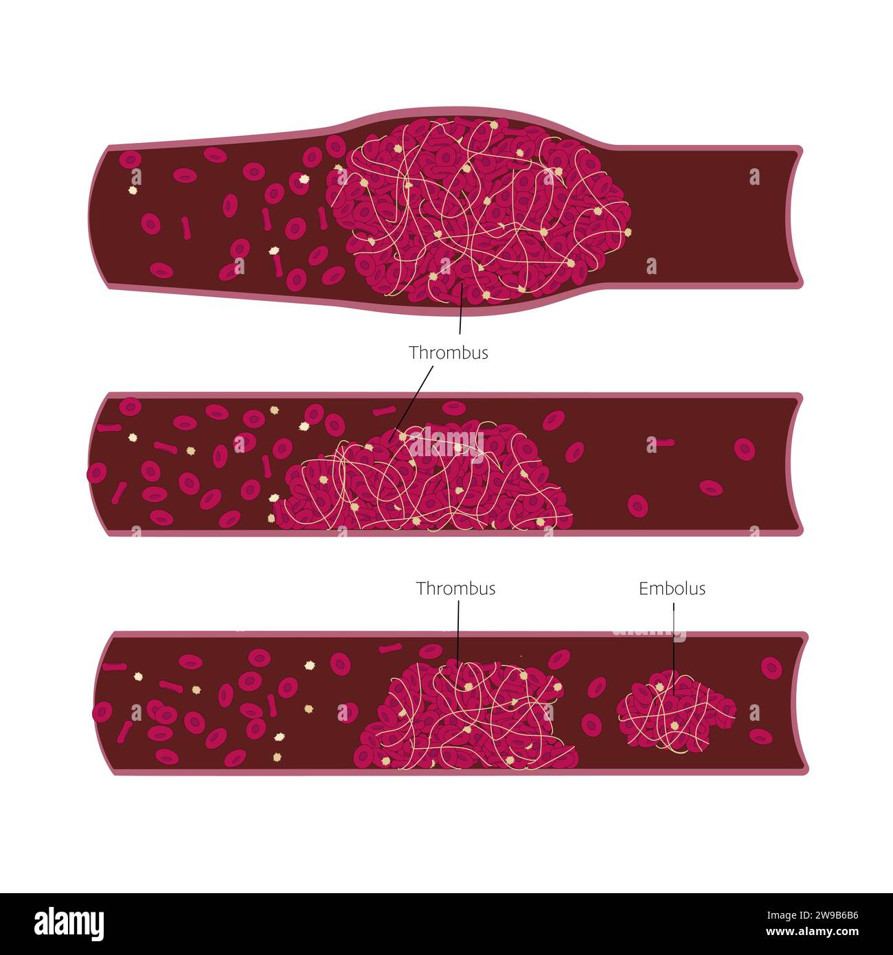 Economy class syndrome Immagini Vettoriali Stock - Alamy