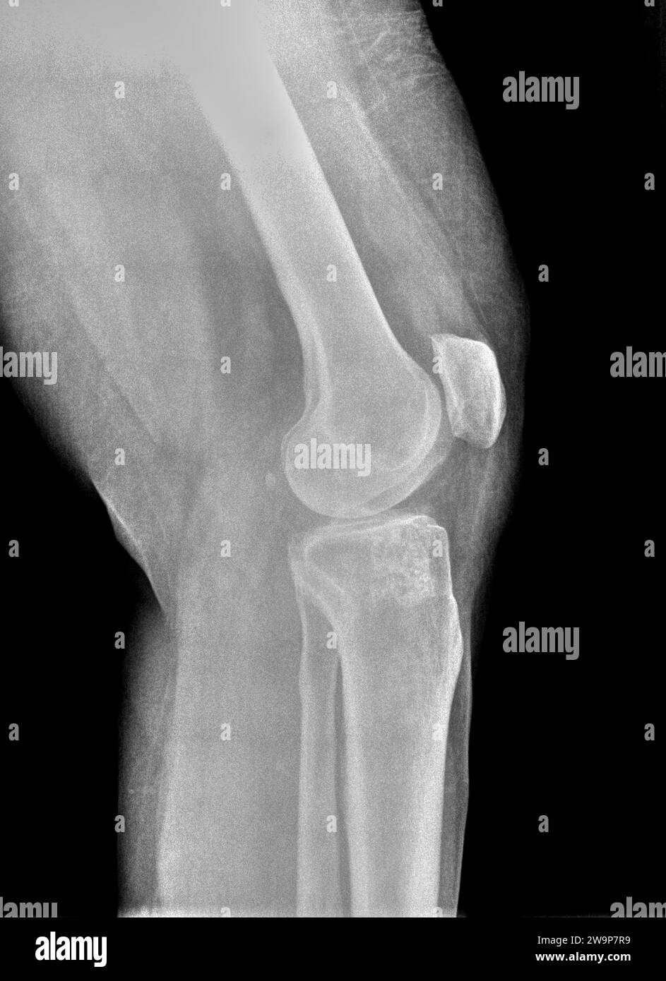 Pellicola radiografica o radiografia di un ginocchio normale. La vista ...