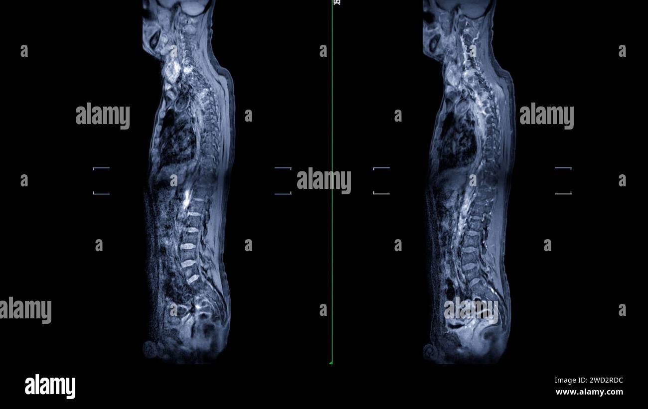 Una risonanza magnetica dell'intera immagine della colonna vertebrale è ...