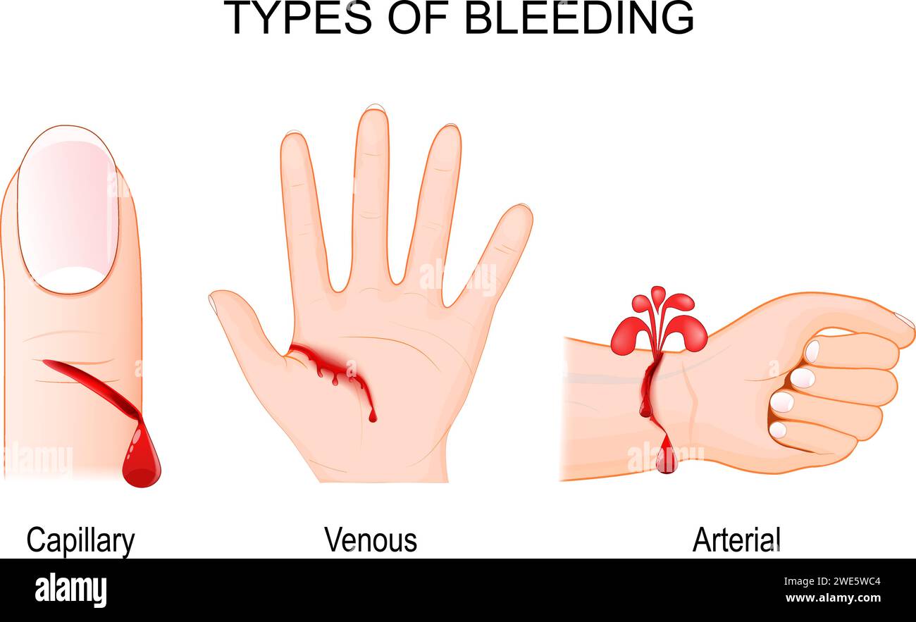 Tipi di emorragia. Una ferita emorragica capillare al dito. Palmo con ...