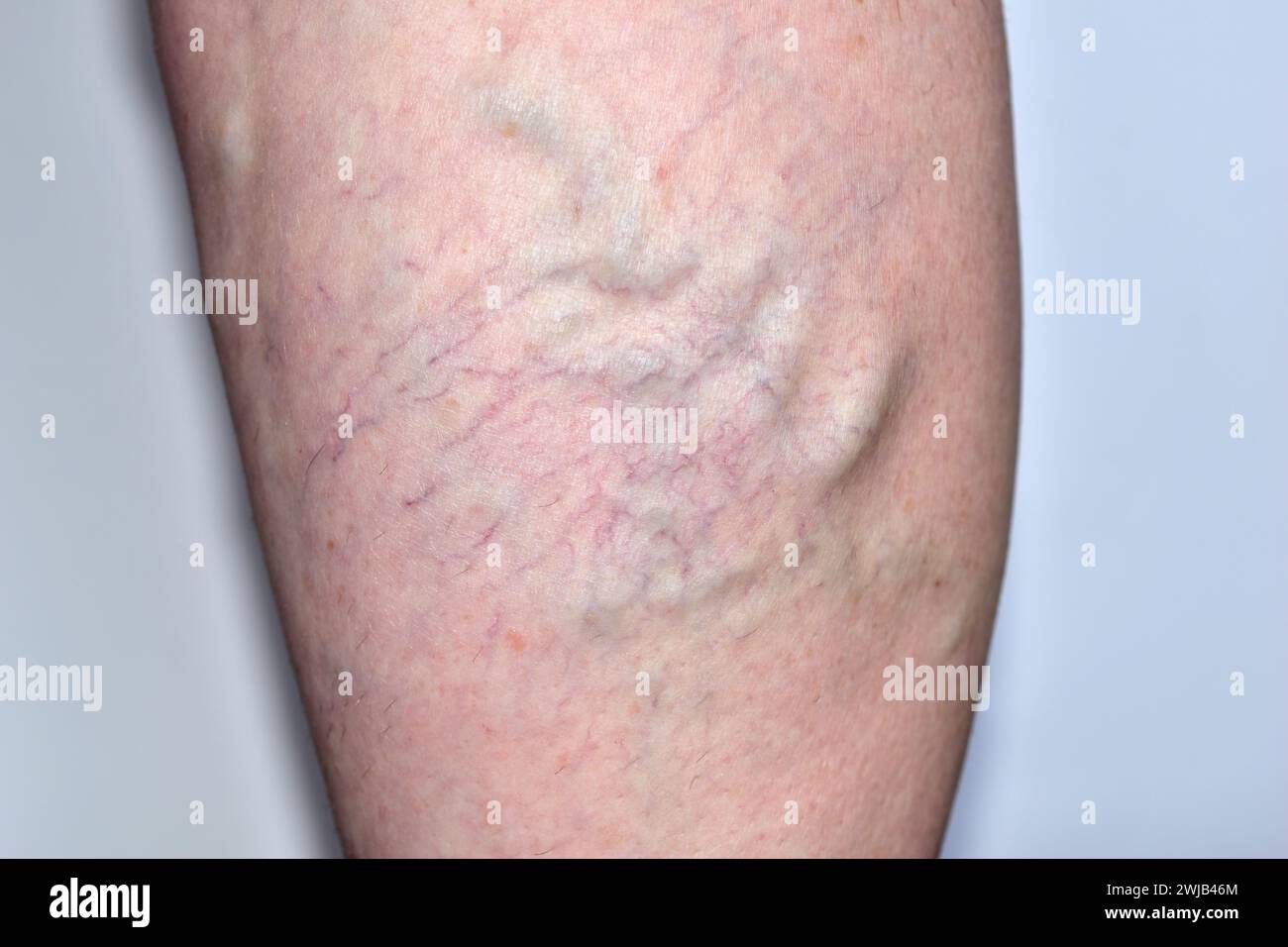 Trombosi delle vene delle gambe immagini e fotografie stock ad alta ...