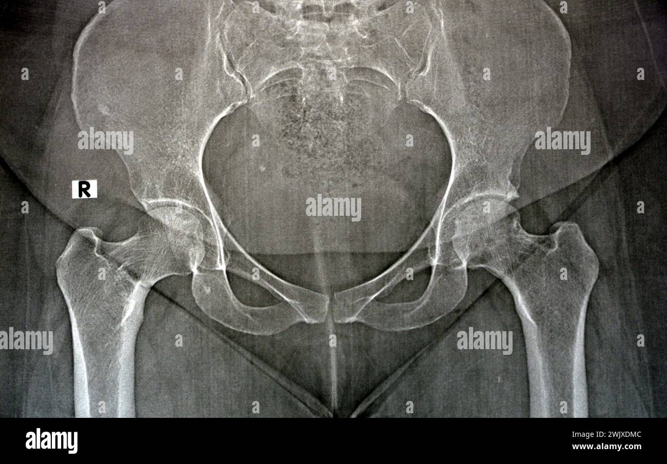 La radiografia semplice rivela necrosi avascolare bilaterale (AVN ...