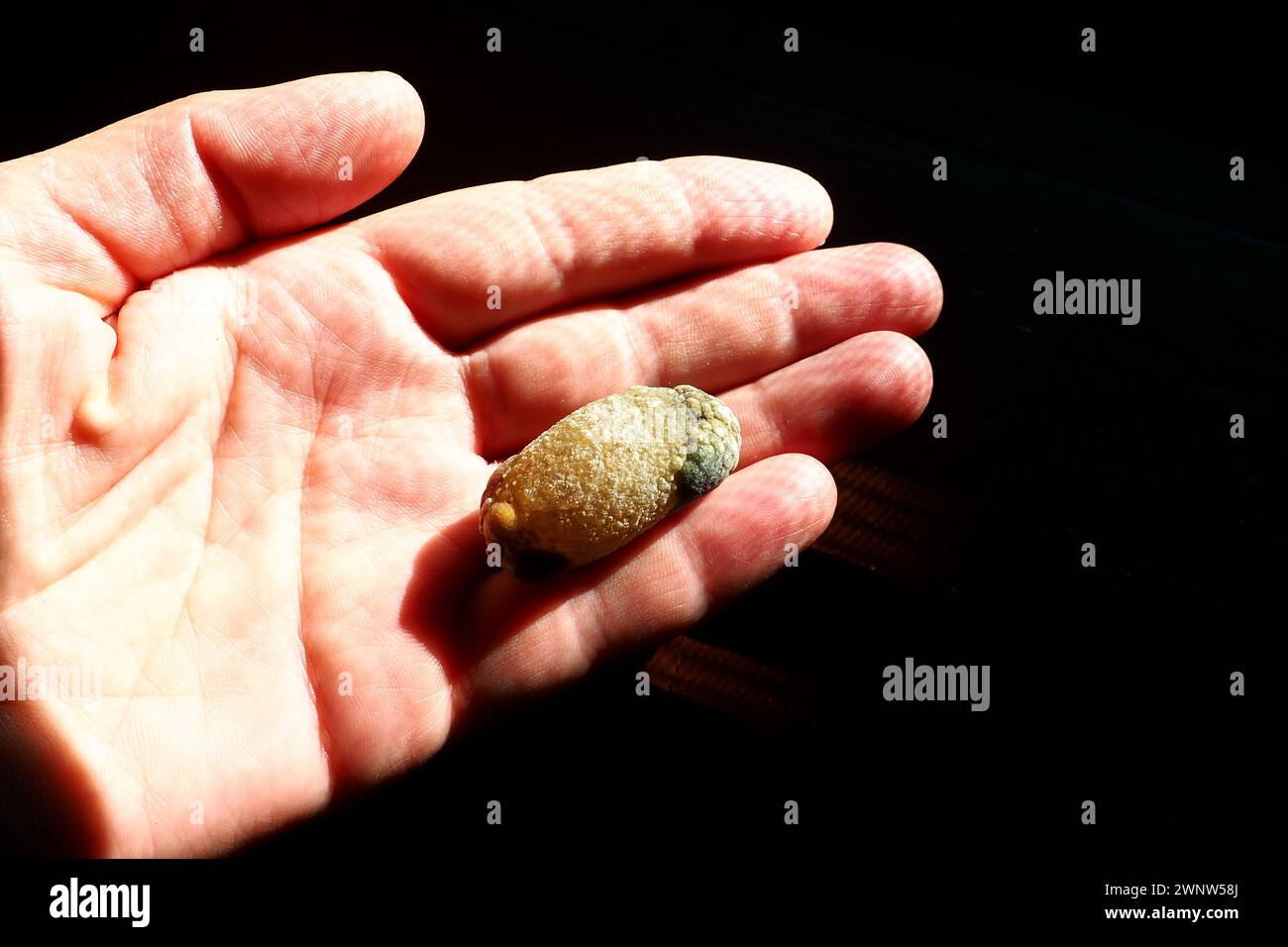 Malattia del calcoli biliari, colelitiasi - la formazione di pietre ...