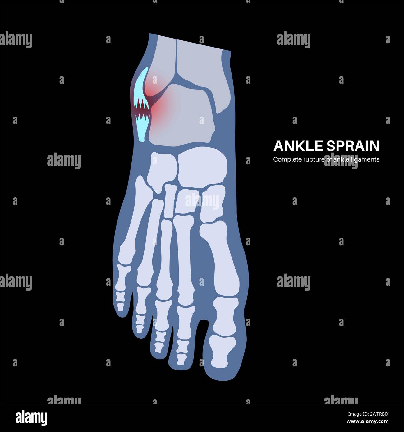 Gonfiore della caviglia immagini e fotografie stock ad alta risoluzione ...
