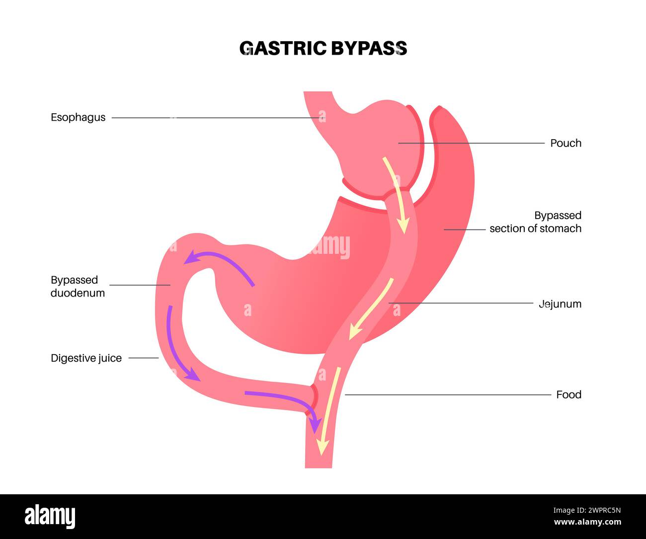 Roux en y bypass gastrico chirurgia bariatrica immagini e fotografie ...