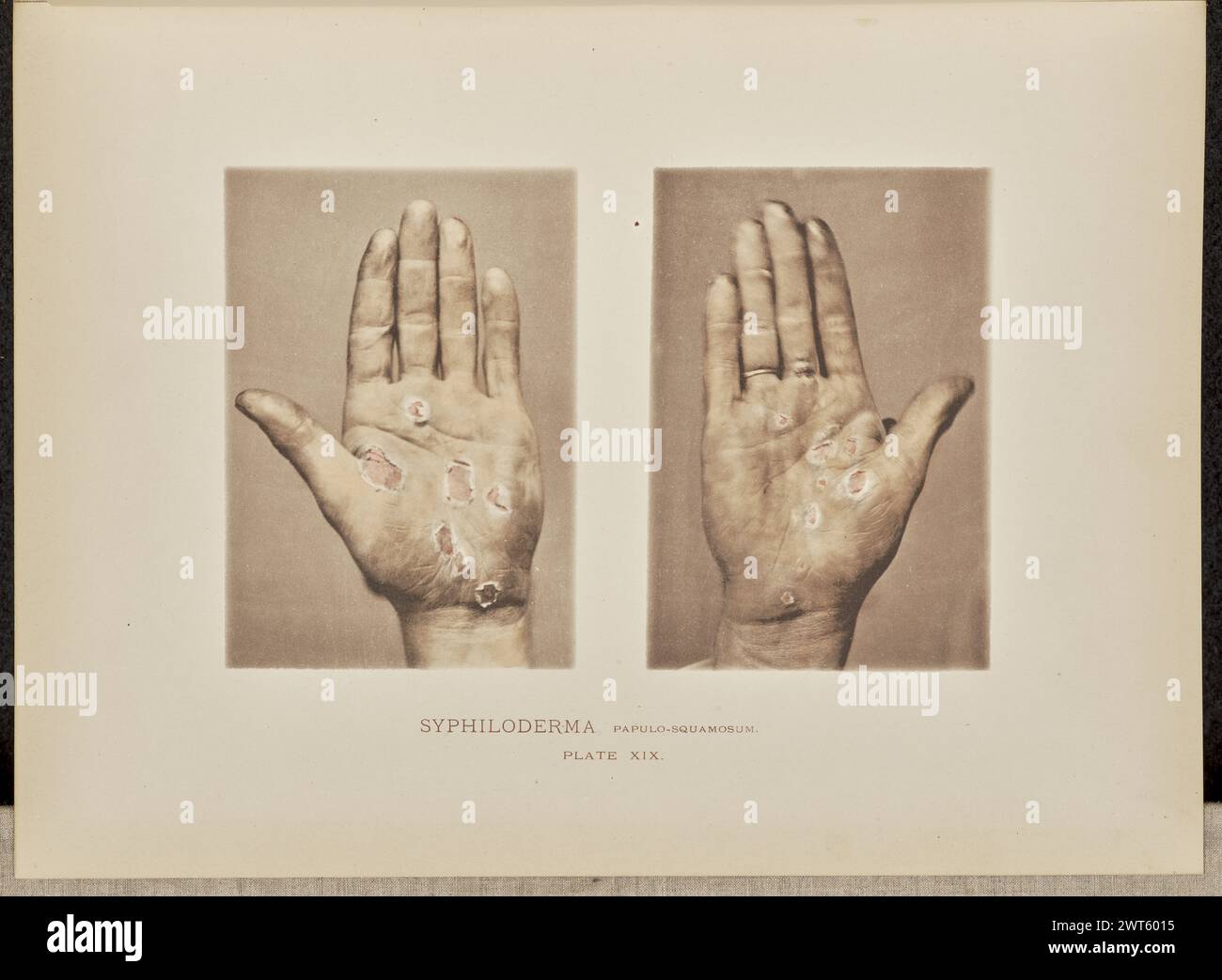 Sifilide squamoso immagini e fotografie stock ad alta risoluzione - Alamy