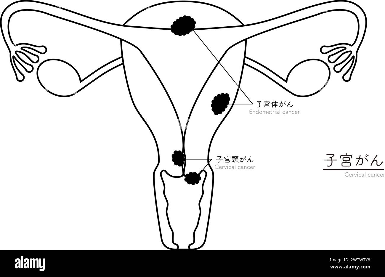 Cancro cervicale uterino Immagini Vettoriali Stock - Alamy