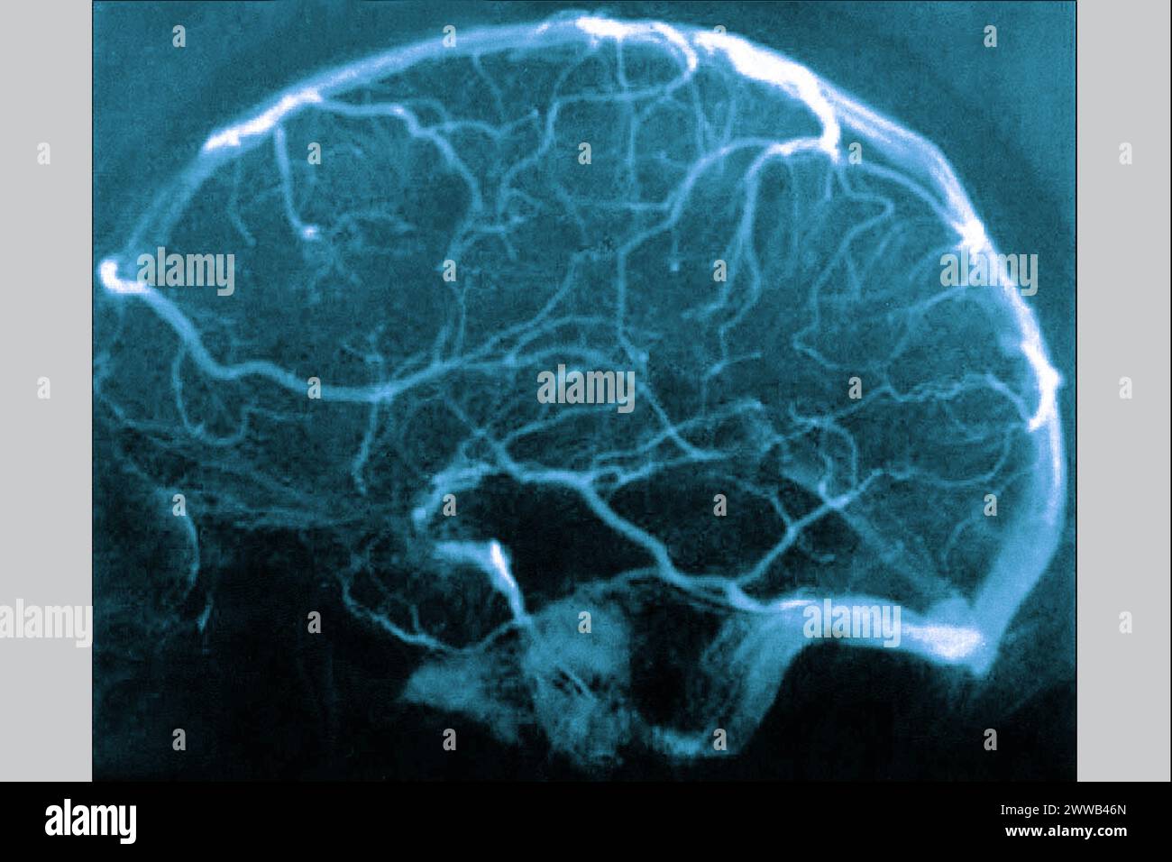 Anatomia delle vene immagini e fotografie stock ad alta risoluzione ...