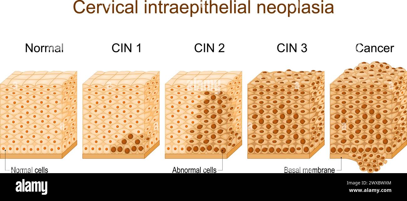 Neoplasia intraepitelial cervical immagini e fotografie stock ad alta ...