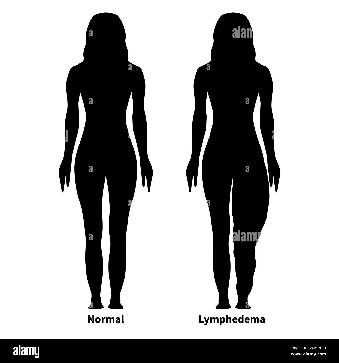 Lymphedema disease Foto e Immagini Stock in Bianco e Nero - Alamy