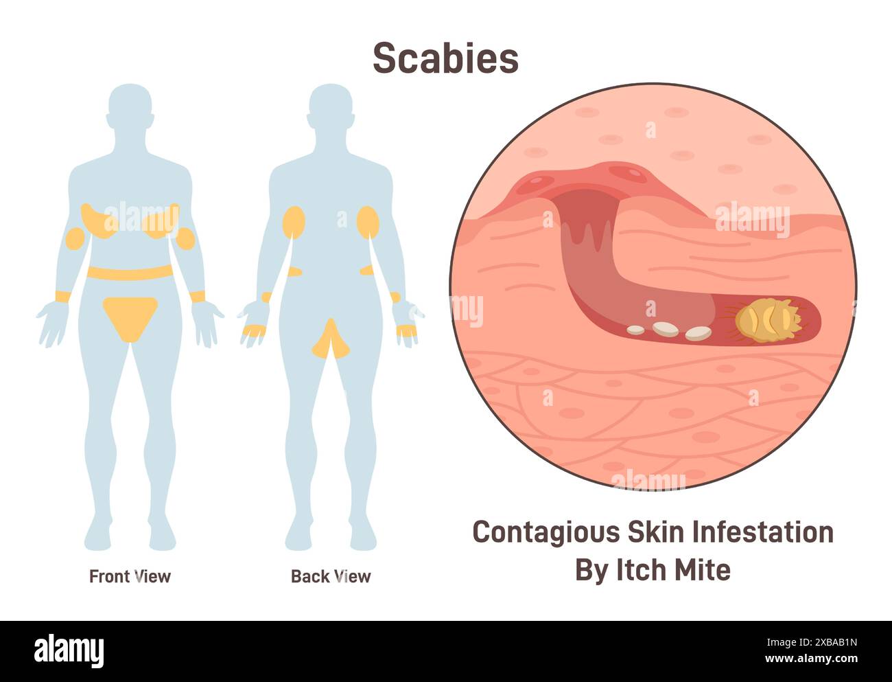 Acaro della rogna Immagini Vettoriali Stock - Alamy