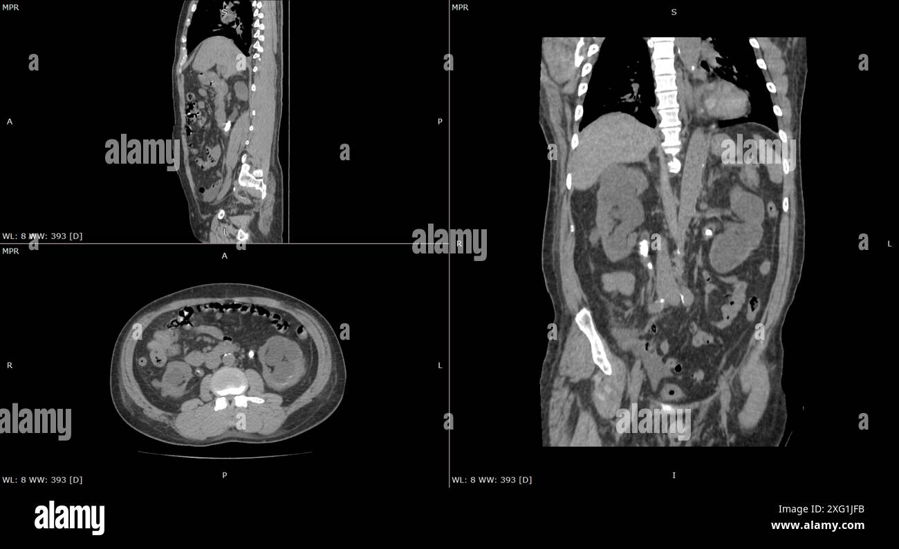Patologia urinaria Foto e Immagini Stock in Bianco e Nero - Alamy