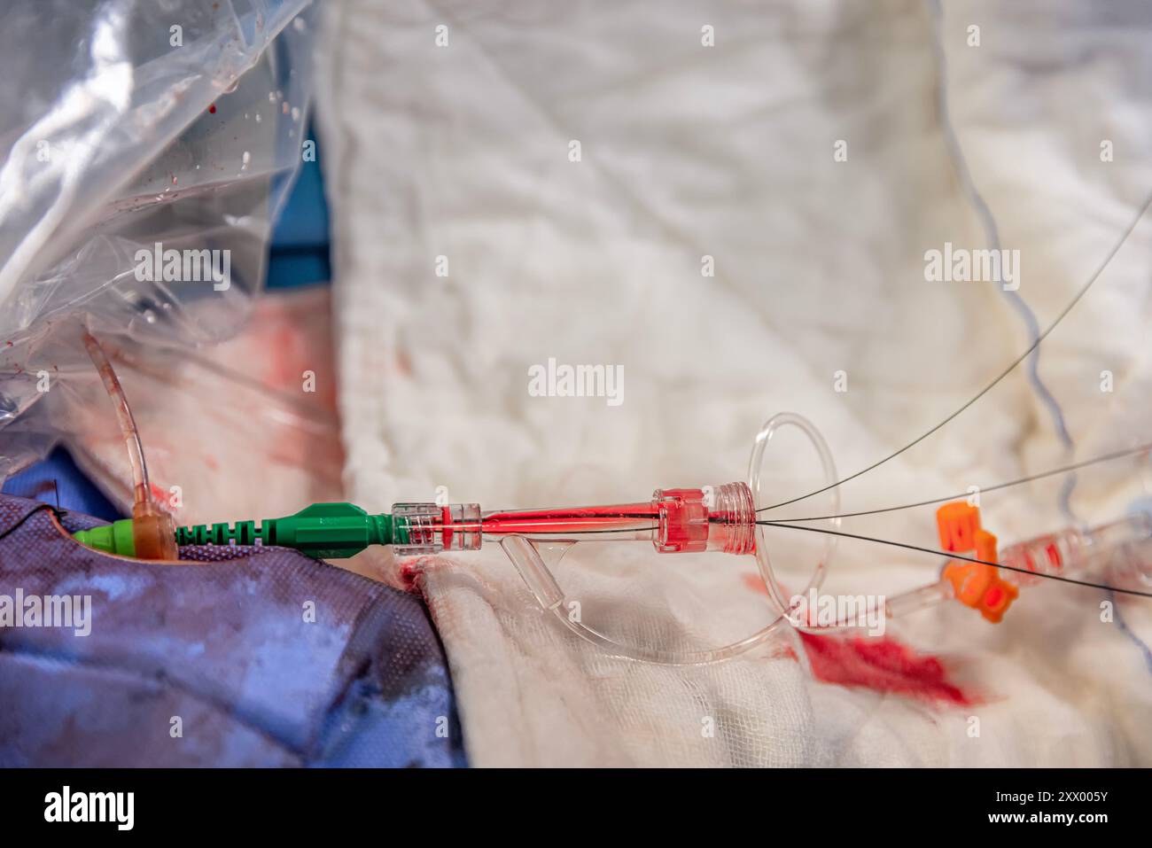 Procedura di posizionamento dello stent cardiaco in sala operatoria ...