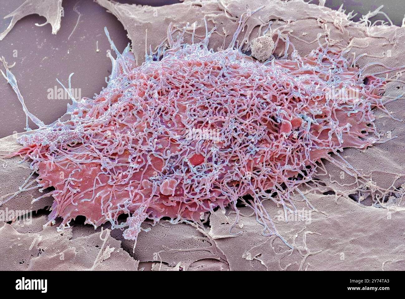 Cellule tumorali ossee. Micrografia elettronica a scansione colorata di ...