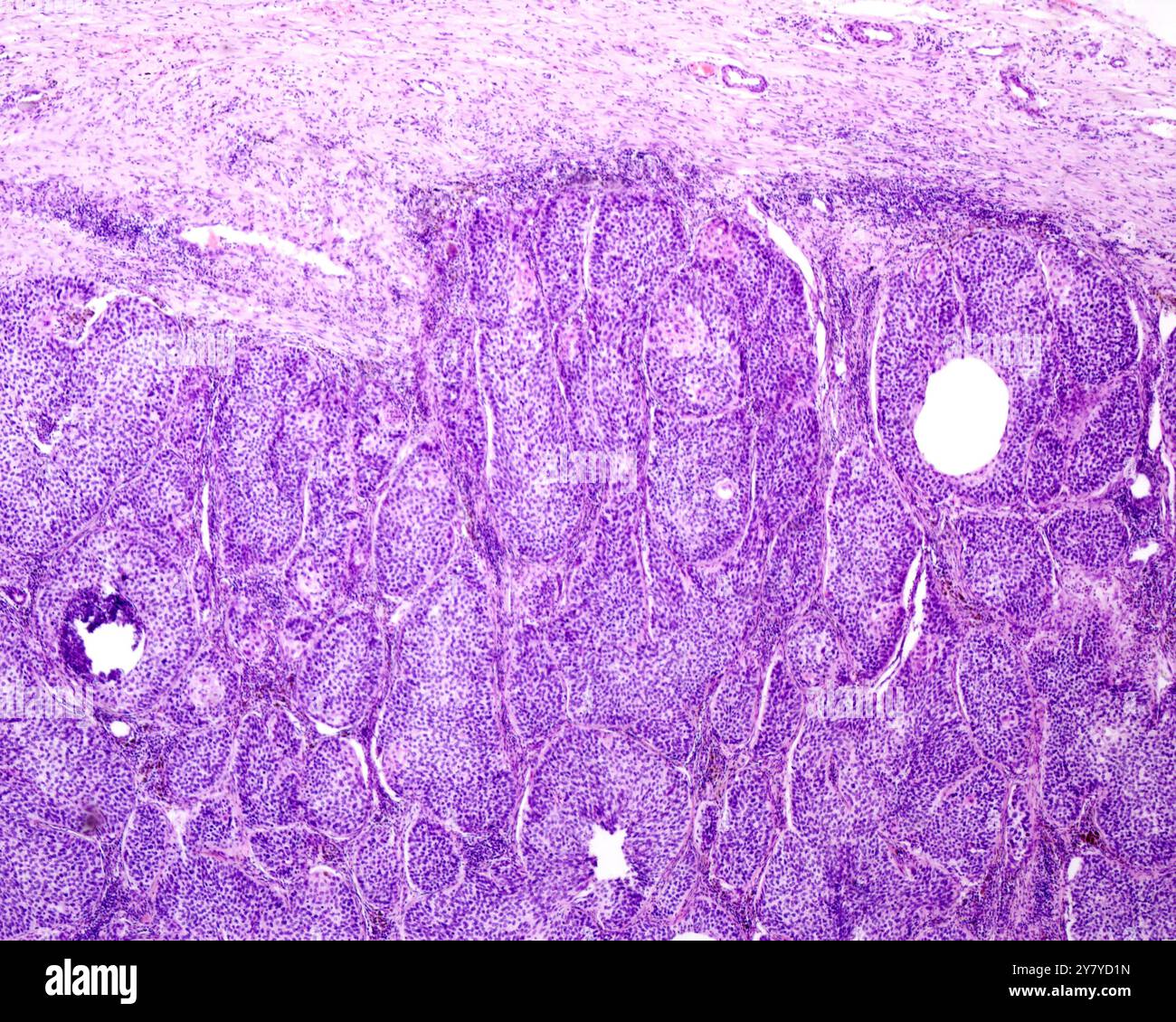 Micrografia leggera di un carcinoma a cellule squamose del polmone ...