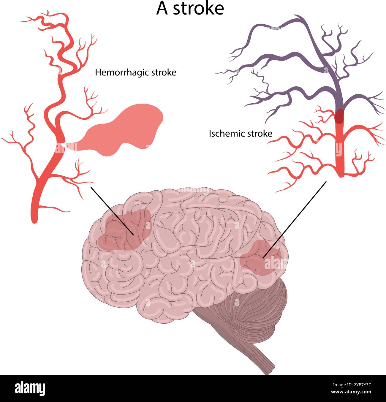 Ischemic stroke Immagini senza sfondo e Foto Stock ritagliate - Alamy