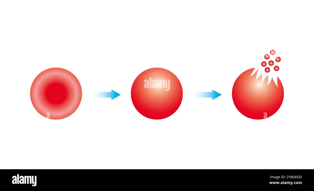 Anemia emolisi immagini e fotografie stock ad alta risoluzione - Alamy