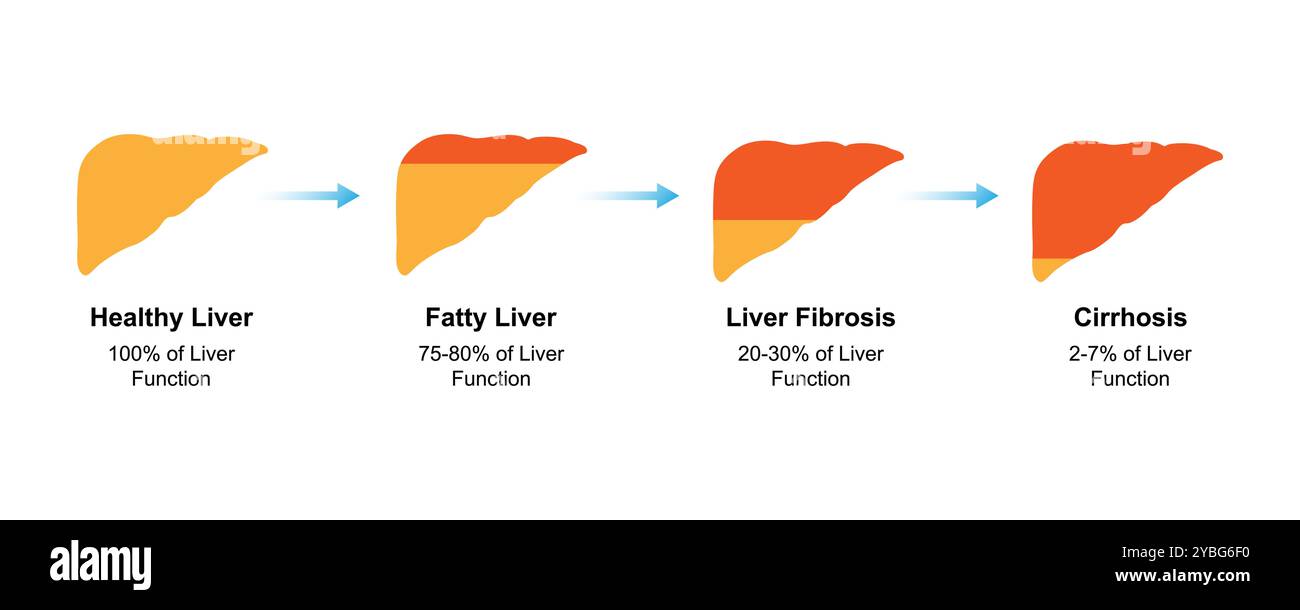 Steatosi epatica alcolica Immagini senza sfondo e Foto Stock ritagliate ...