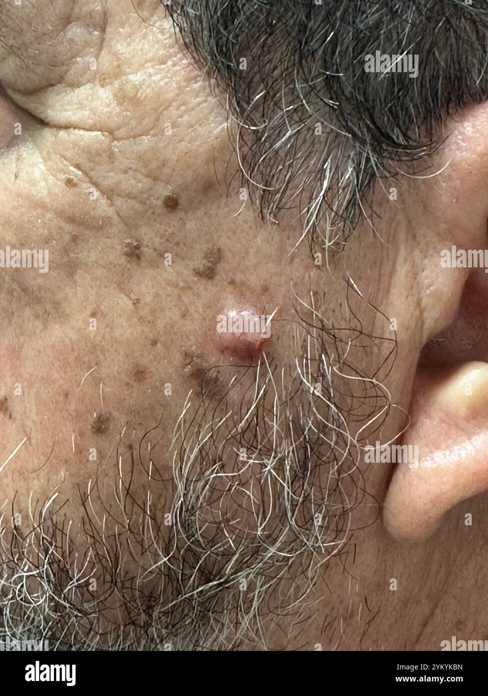 Carcinoma nodulare a cellule basali (BCC), o ulcera dei roditori, su ...