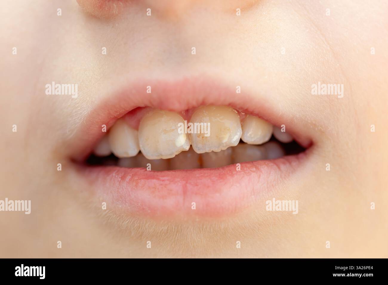 I primi molari immagini e fotografie stock ad alta risoluzione - Alamy