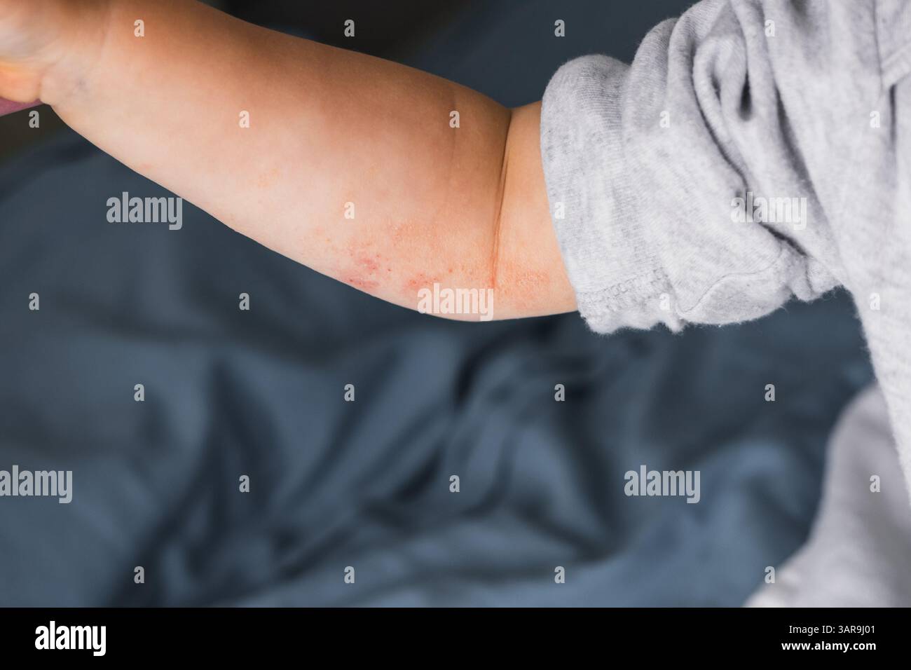 Dermatite atopica bambini immagini e fotografie stock ad alta ...