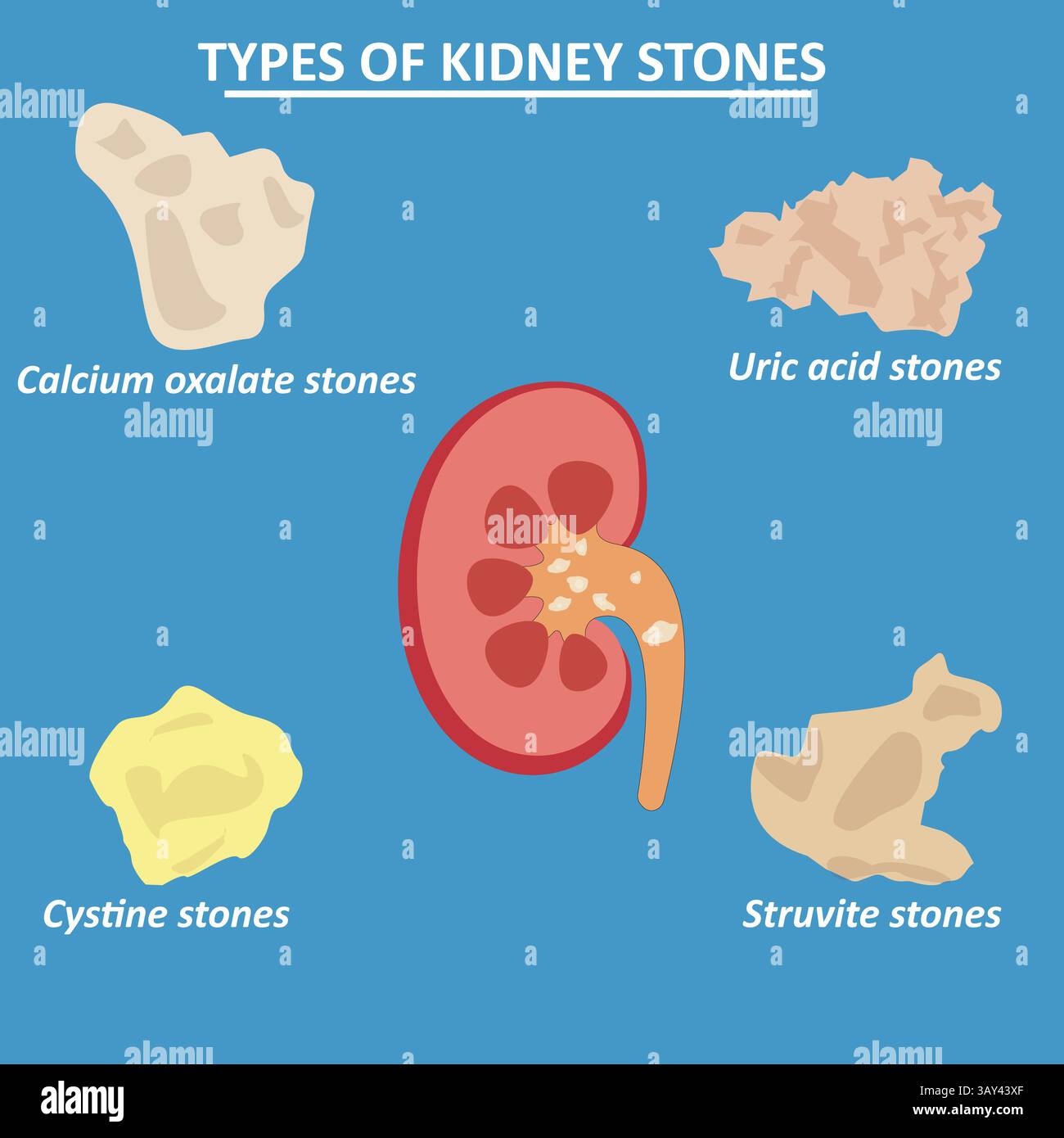 Calcoli di ossalato di calcio immagini e fotografie stock ad alta ...