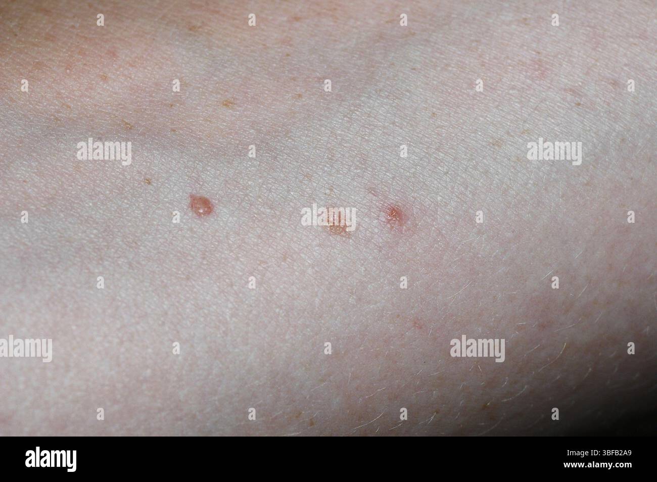 Morsi delle pulci immagini e fotografie stock ad alta risoluzione - Alamy