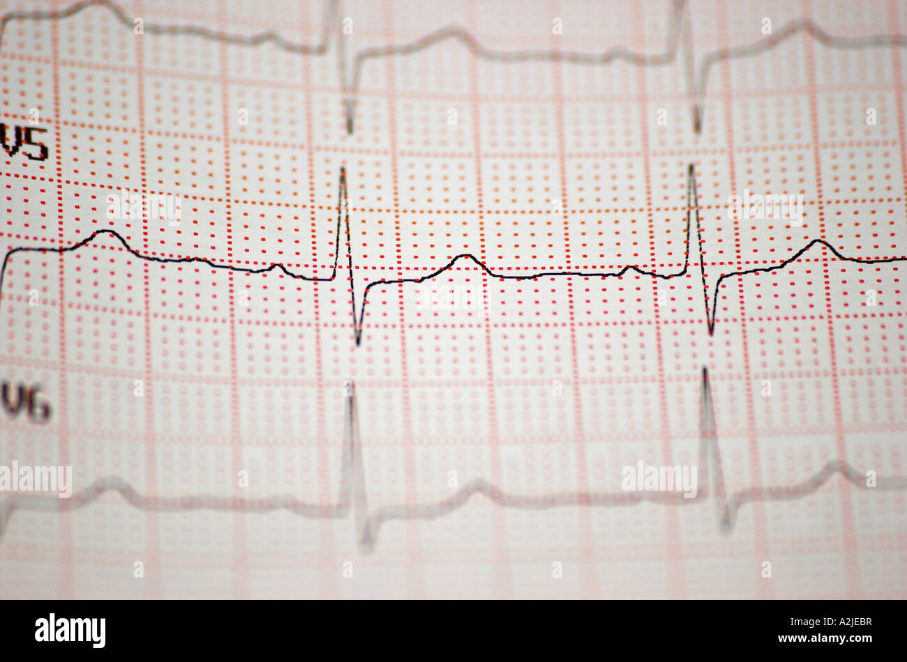 Tracciato ecg normale immagini e fotografie stock ad alta risoluzione ...