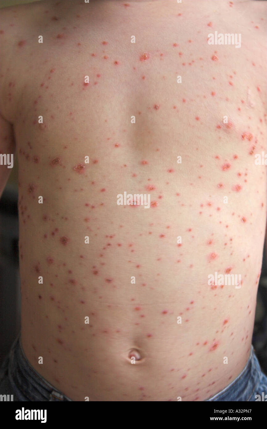Croste da varicella immagini e fotografie stock ad alta risoluzione - Alamy