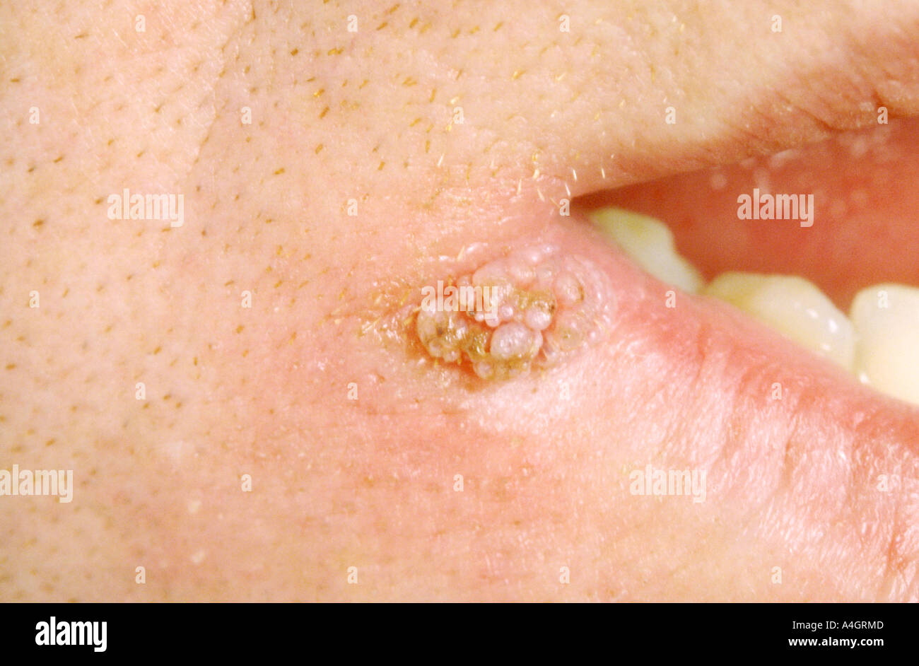 Verruca sul viso immagini e fotografie stock ad alta risoluzione - Alamy