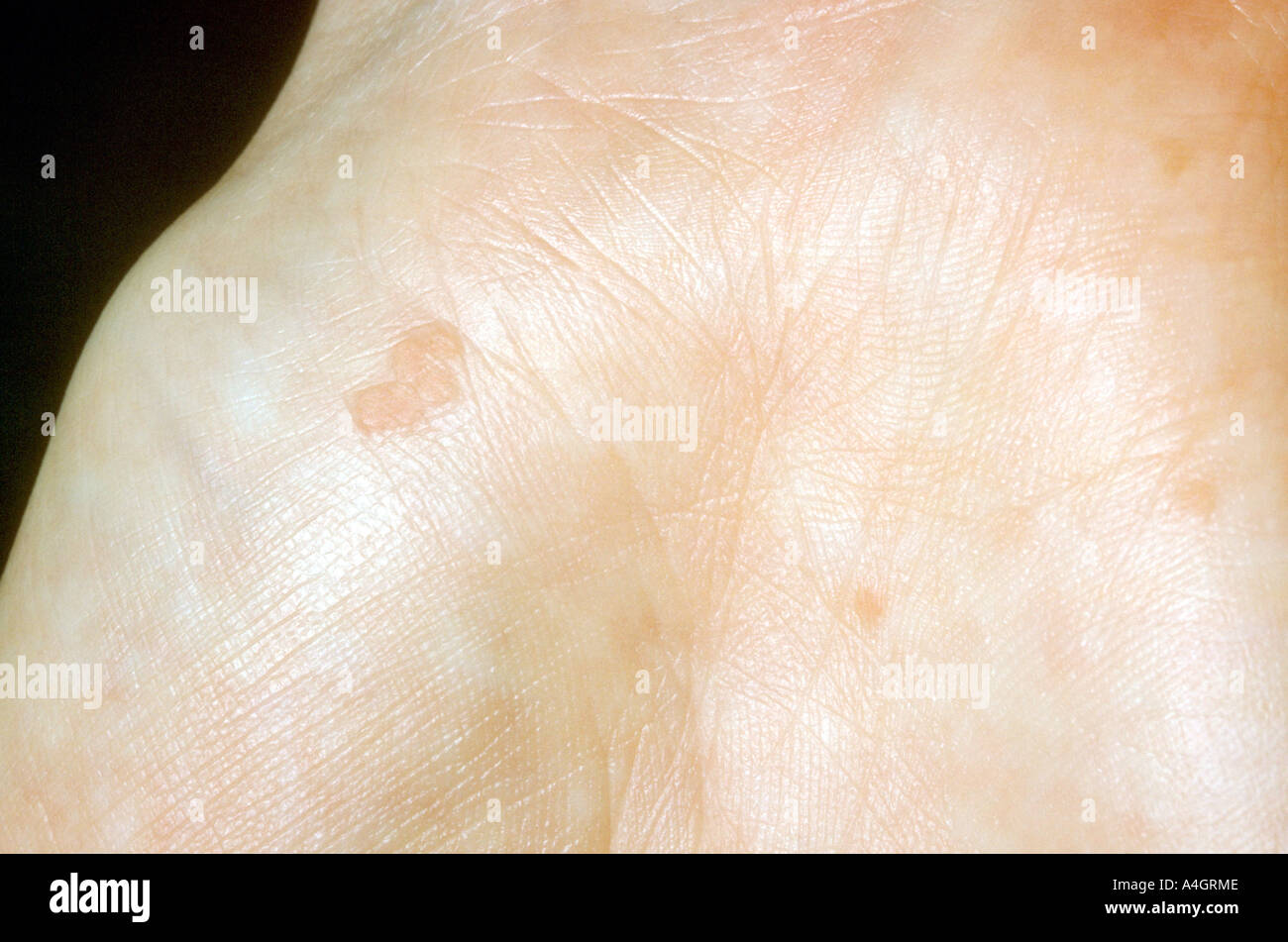 Verruca plana è un piccolo, color carne, con sommità piatta lesione che ...