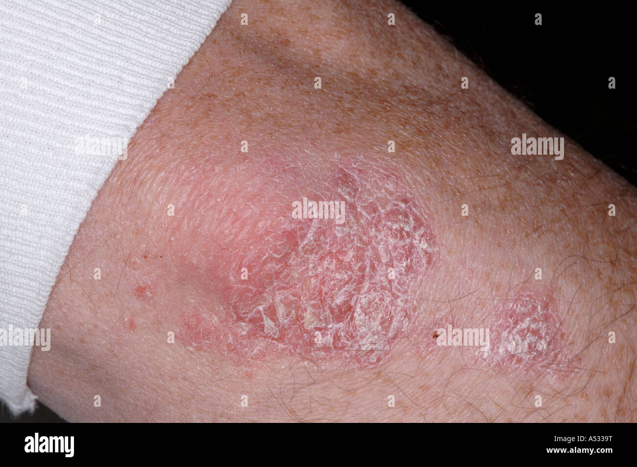Psoriasis vulgaris immagini e fotografie stock ad alta risoluzione - Alamy
