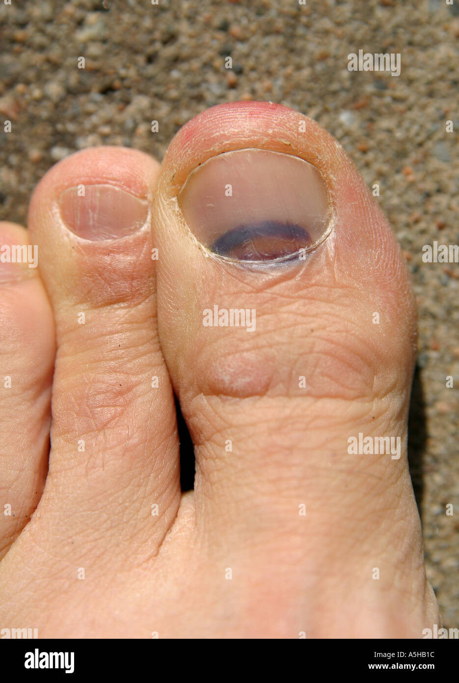 Livido delle unghie immagini e fotografie stock ad alta risoluzione - Alamy