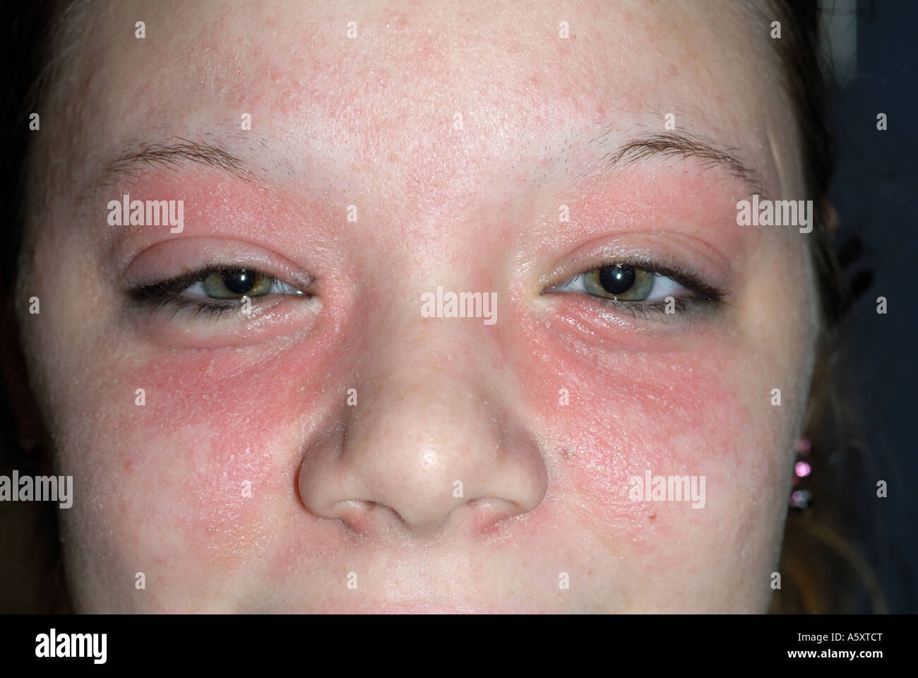 Rash cutaneo di dermatite da contatto sul viso di un vecchio anno 16 ...