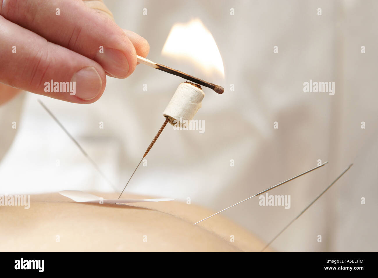 Terapia con moxa immagini e fotografie stock ad alta risoluzione - Alamy