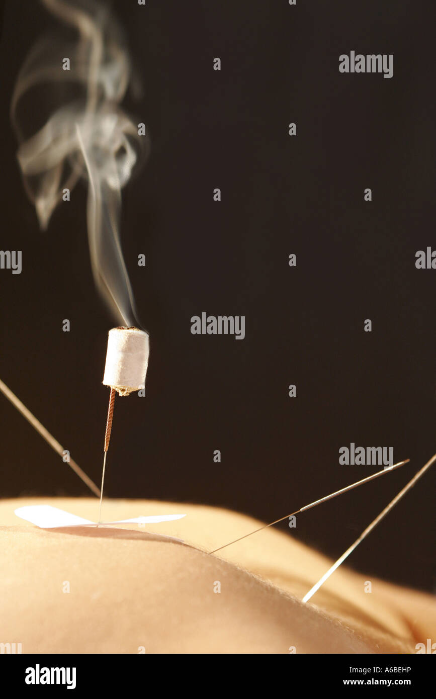 Terapia con moxa immagini e fotografie stock ad alta risoluzione - Alamy