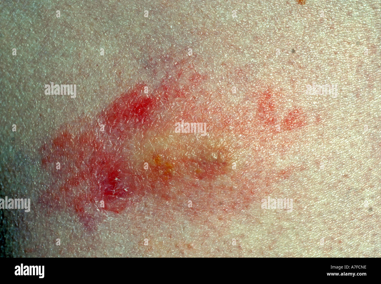 Herpes vesicles immagini e fotografie stock ad alta risoluzione - Alamy