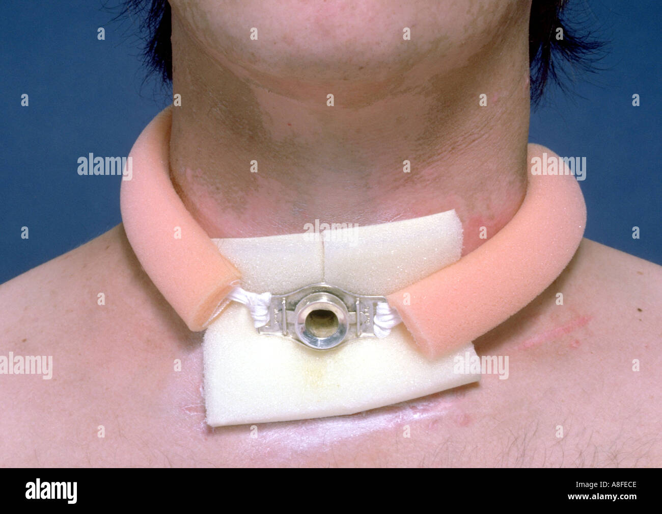 Tracheostomy tracheotomy immagini e fotografie stock ad alta ...
